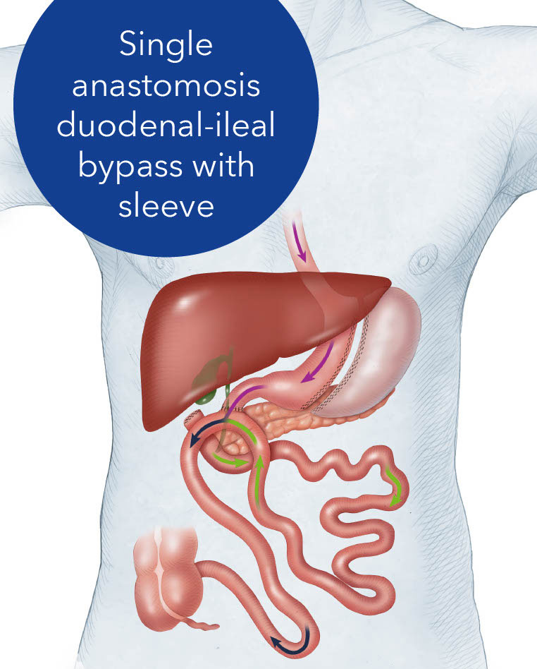 SADI S Single Anastomosis Duodenal Ileal Bypass With Sleeve SADI S Single Anastomosis Duodenal Ileal Bypass With Sleeve